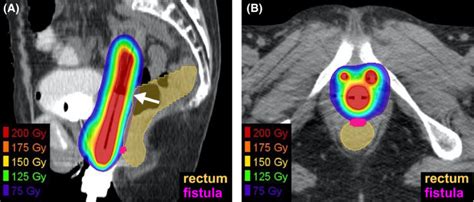 Rectovaginal Fistula In A Cervical Cancer Patient Treated With