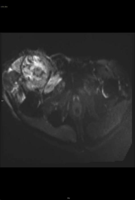 High Grade Sarcoma Right Inguinal Region Body Mr Radiology Case