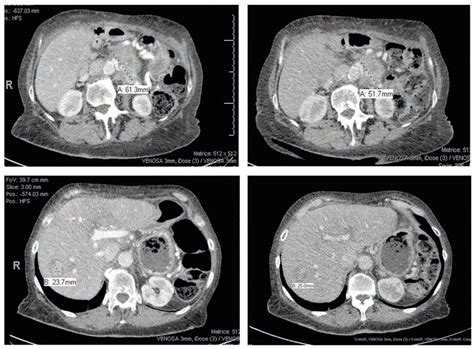 Pancreatic Carcinoma Ct