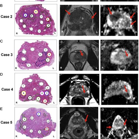 Correlation Between Histological Characteristics And Visibility On