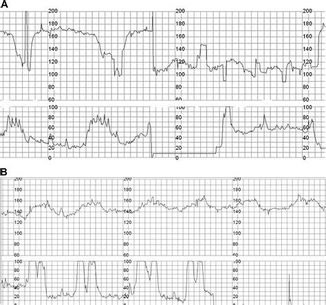 technical update no 429 maternal heart rate artefact during