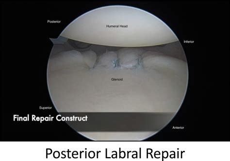 Posterior Labral Repair Using Knotless “all Suture” Suture Anchors