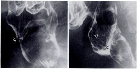 Nodular Mucosa In Pharyngeal Carcinoma In 43 Year Old Woman With Known Download Scientific