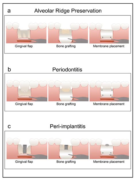Illustration Representing The Surgical Protocol For Alveolar Ridge