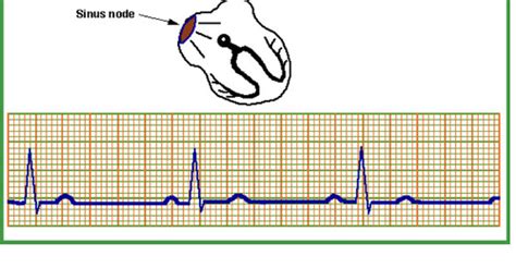 Cardio Rhythms Flashcards Quizlet