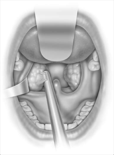 Microdebrider Assisted Tonsillectomy Pocket Dentistry