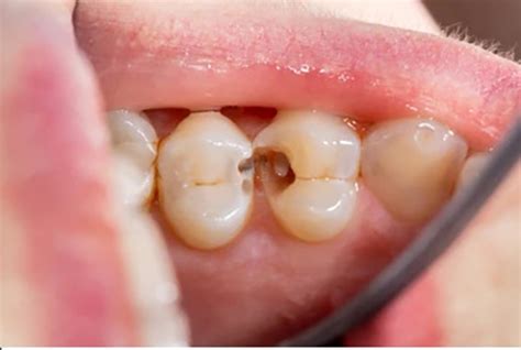 Sequelae Of Dental Caries Dr Praveens Dental