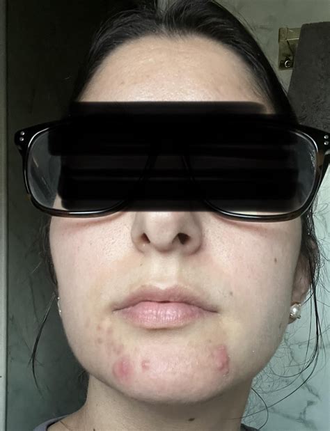 Diagnosed With Rosacea In April And Have Been On 40mg Doxycycline And