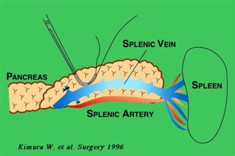 Spleen‐preserving distal pancreatectomy with conservation of the splenic artery and vein ...