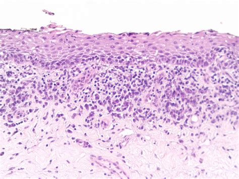 Баланопостит у мужчин Причины симптомы лечение профилактика