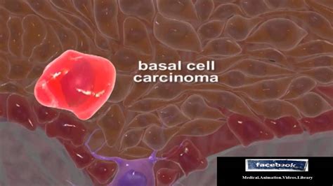 Basal Cell Carcinomas Medical Animation Video 3d Youtube