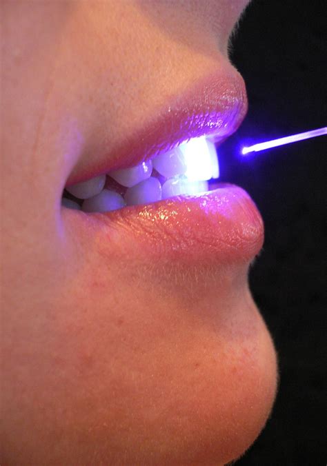 Dentistry | International Society for Medical Laser Applications