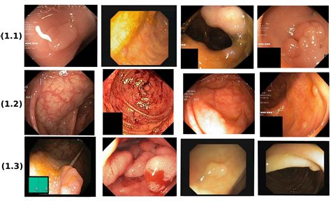 Transrupnet For Improved Polyp Segmentation Ai Research Paper Details