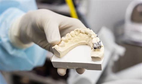 Removing Dental Cement From Crown How To Do It