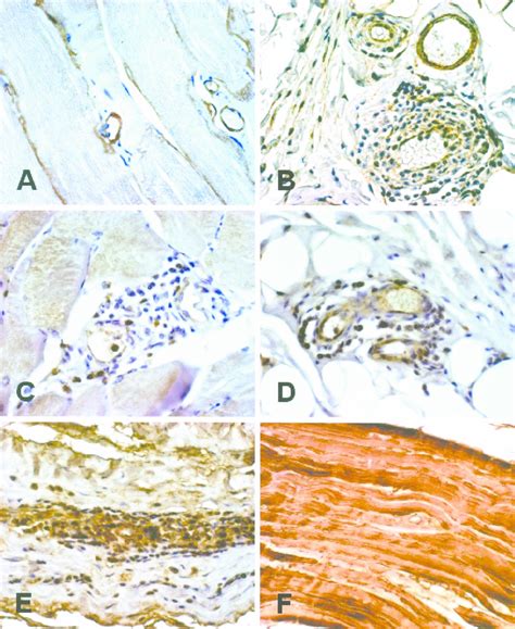 A F Expression Of Factors Related To Angiogenesis In Inflammatory