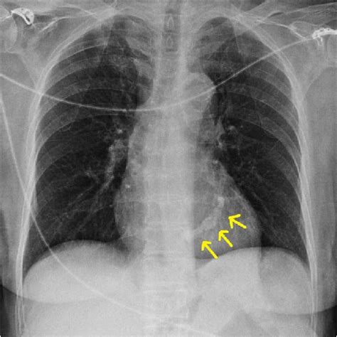 Computed Tomography Displaying Mitral Annulus Calcification Yellow