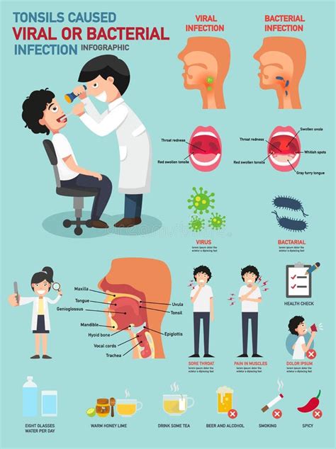 Infección Bacteriana De La Garganta Inflamación De Las Amígdalas