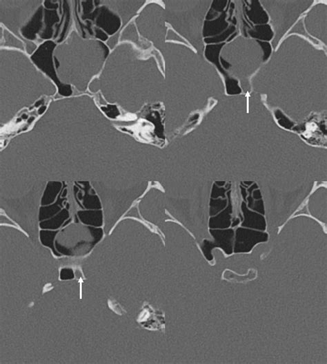Jnajuvenile Nasopharyngeal Angiofibroma — Preoperative Embolization