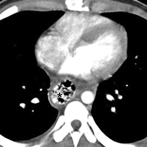 Torn Esophagus During Endoscopy At Norma Mitchell Blog