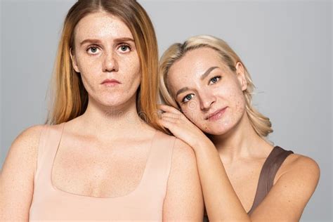 Blonde Woman With Acne On Face Stock Image Image Of Problem Pretty 273995419