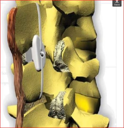 Principles of effective dynamic stabilizations Professor G Sapkas Ορθοπεδικός Χειρουργός
