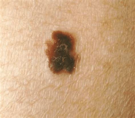 If Your Mole Looks Like This Its Time To See A Dermatologist
