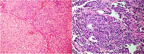 Histopathological Examination Of Bladder Neoplasms Including Low Grade