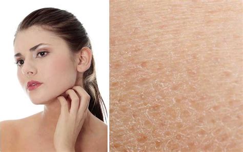 Mercury Skin Rash Chronic Mercury Intoxication Masquerading As