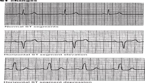 Improve Acs Outcomes By Ecg Assessment Nursing2020 Critical Care