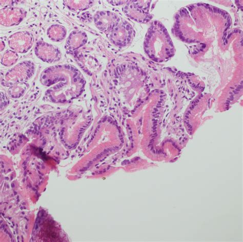Histopathology Intestinal Metaplasia Kaggle