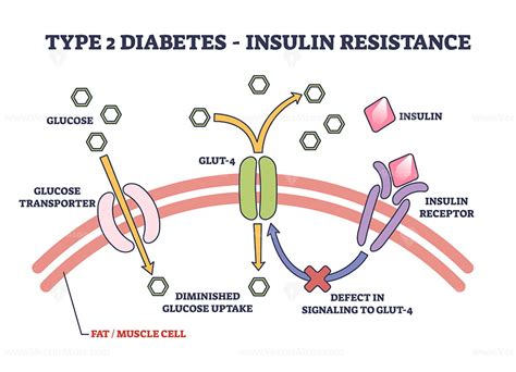 Type 2 Diabetes And Insulin Resistance Anatomical Explanation Outline