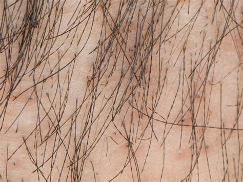 40 Facts About Monilethrix