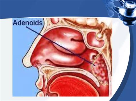 Adenoids Pptx