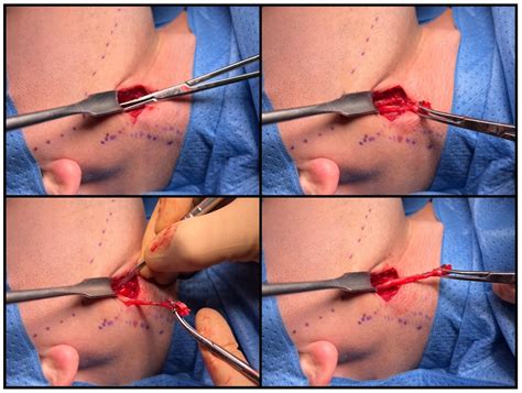 Minimally Invasive Cervical Styloidectomy In Stylohyoid Syndrome Eagle