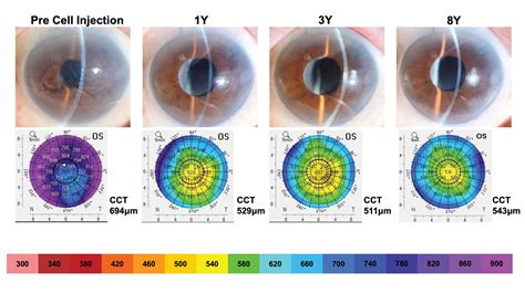 The Future Of Corneal Transplantation Ophthalmology Management