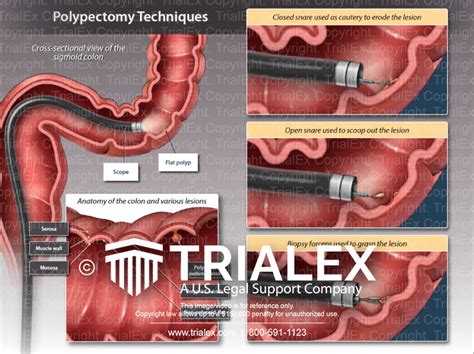 Polypectomy Techniques Trialexhibits Inc