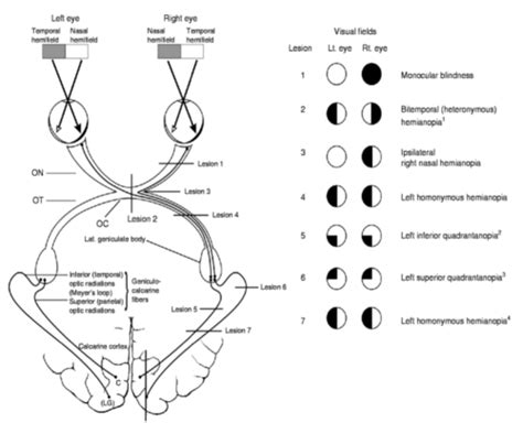 Aandp 3 Lec 13 Visual Pathway Flashcards Quizlet