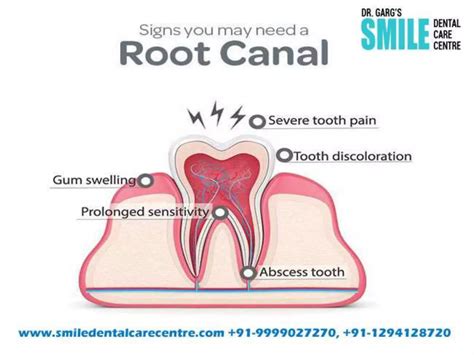 What Are The Side Effect And Dangers Of Root Canal Treatment Pptx