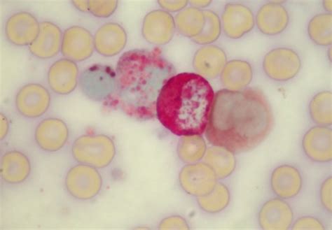 Cytochemical Stain Pattern In Aml With Inv 16