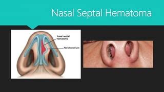 Nasal Septal Hematoma Drainage Pptx