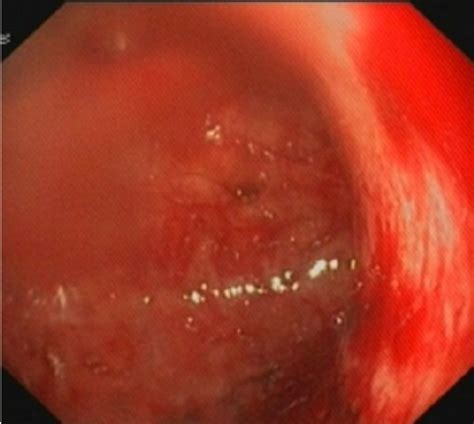 Middle Third Of Esophagus Download Scientific Diagram