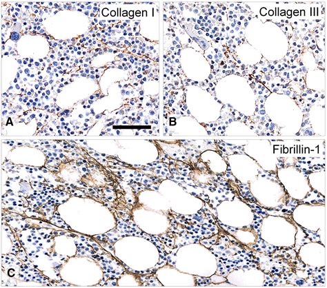 Myelofibrosis Progression Grading Based On Type I And Type Iii Collagen