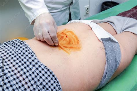 An Injection In The Lumbar Region For Problems With The Spine And Pinching Of The Sciatic Nerve