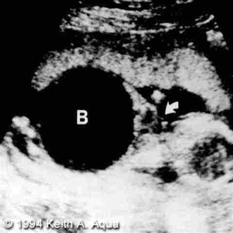 Prune Belly Syndrome Ultrasound