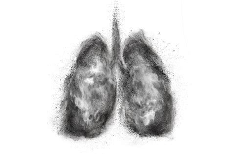 Serplulimab Chemo Shows Promise For Squamous Nsclc Multidisciplinary