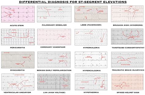 Differential Diagnosis For St Segment Elevations Infographic R