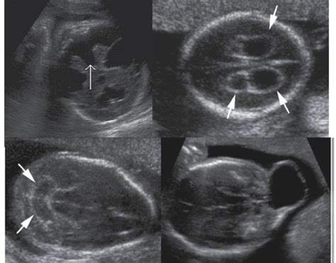 Brain Malformations 2 Quiz