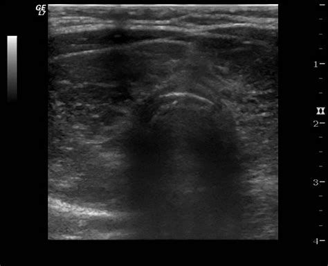 Heterogeneous Hypervascular Thyroid Gland