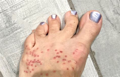 Chiggers Bites Look Like