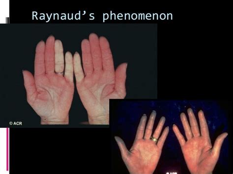 Scleroderma